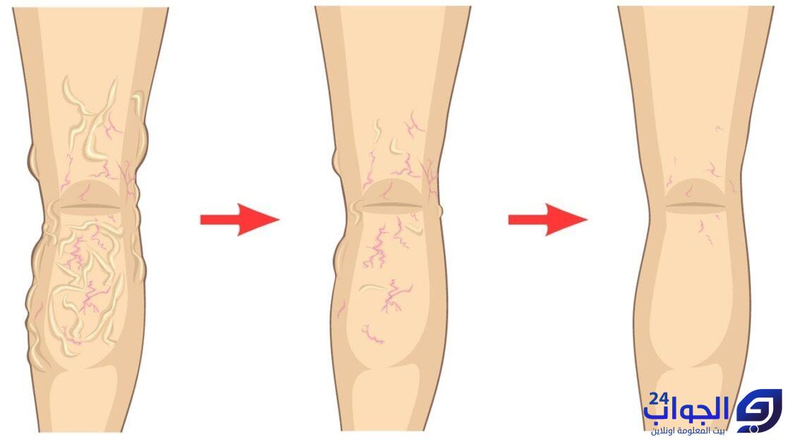 حقن ديفارول اس Devarol S لعلاج نقص فيتامين د .. دواعي الاستعمال والجرعة